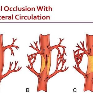 EECP Therapy in Penang: A Non-Invasive Option for Heart Disease & Stroke Recovery - EECP Centre ...